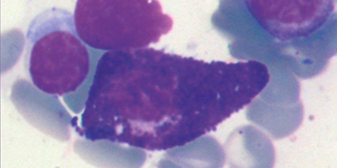 Quando suspeitar de mastocitose e como confirmar o diagnóstico ...